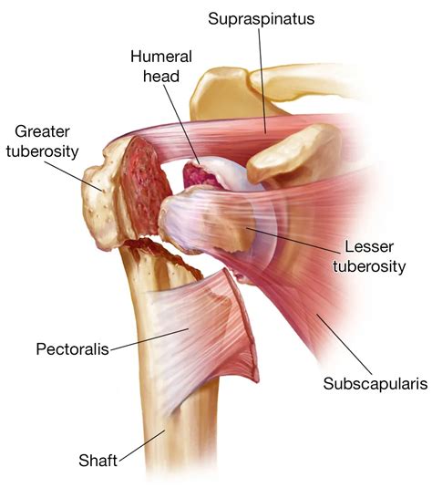 Proximal Humerus Fracture Dont Ignore A Broken Shoulder