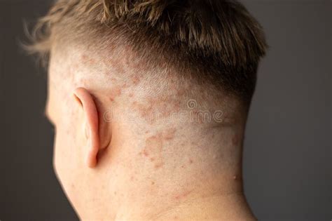 Psoriasis On The Skin Close Up Scalp Photos Of Dermatitis And Eczema