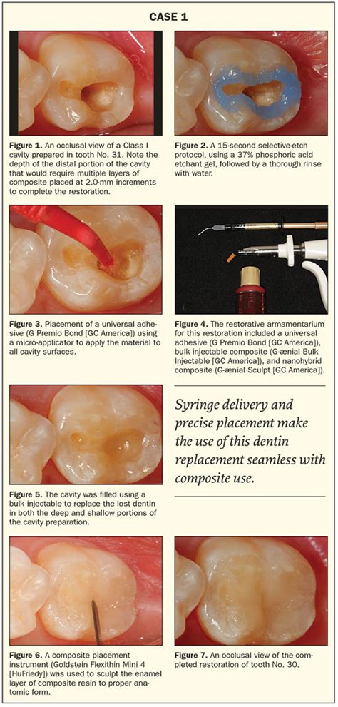 Material Options For Class Ii Composite Restorations Varied Clinical