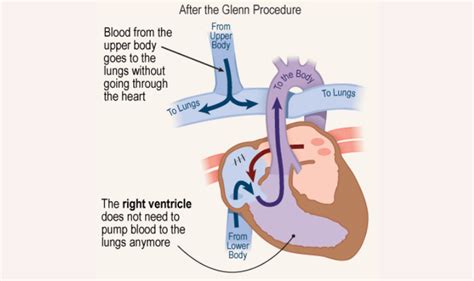 Understanding The Glenn Procedure A Comprehensive Guide For Indian