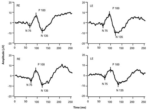 Transient Pattern Reversal Visually Evoked Potentials Of The Right And Download Scientific