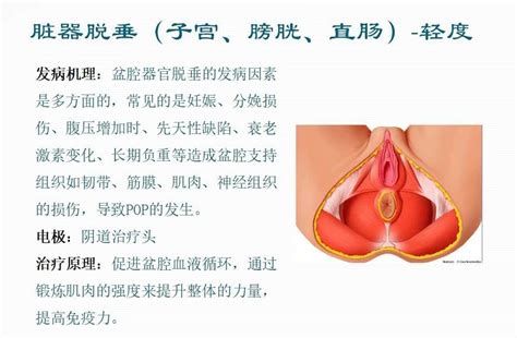 【心至柔母婴健康】盆腔脏器脱垂，女性难以言述的烦恼治疗
