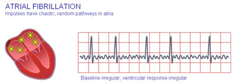 Atrial Fib Vs Atrial Flutter EKG Education And Training EMT City