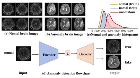 Brain Tumor Anomaly Detection Via Latent Regularized Adversarial