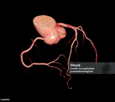 Ct 심장 3d 또는 Cta 관상 동맥 0명에 대한 스톡 사진 및 기타 이미지 0명 Stenosis 가슴대동맥 Istock