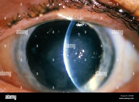 Keratitis Hi Res Stock Photography And Images Alamy
