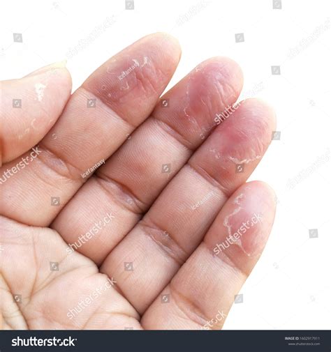 Dyshidrotic Eczema Finger Tips At Helen Breen Blog