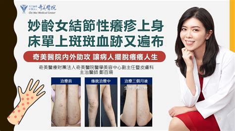 妙齡女飽受結節性癢疹三年多搔癢無止境，生物製劑治療終結劇癢噩夢！ 全國旅遊時報