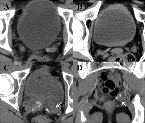 Ct Imaging Of Ejaculatory Duct Tb Jmdh