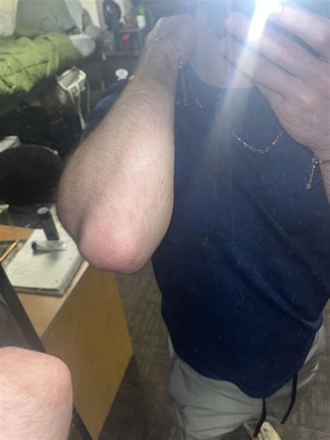 Do I Have Ringworm On My Elbow Rdermatologyquestions