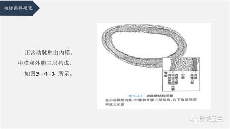 动脉粥样硬化和冠状动脉粥样硬化性心脏病（上） 动脉粥样硬化 冠状动脉 心脏病 围术期 冠心病 麻醉 药物 健康界