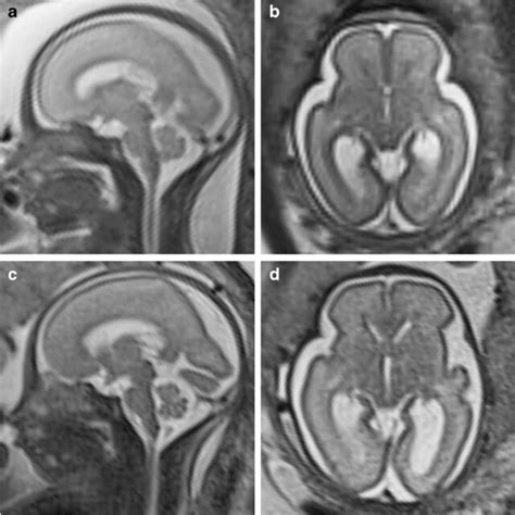 Torcular Pseudomass Imaging Features On Fetal Mri Of The Central