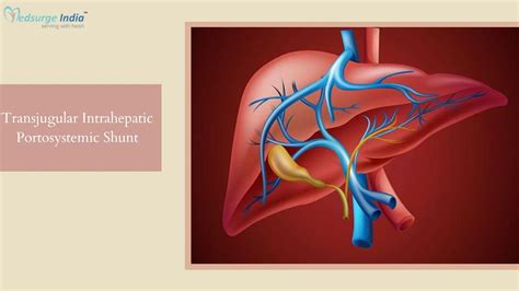 Transjugular Intrahepatic Portosystemic Shunt Future Directions In
