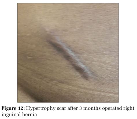 Complications Of Prosthetic Mesh Repair Lichtenstein Method Of