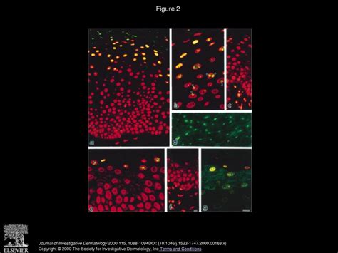 Mutant Loricrin Is Not Crosslinked Into The Cornified Cell Envelope But