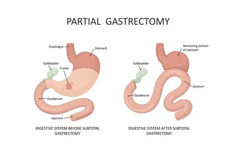 Total Gastrectomy For Stomach Cancer
