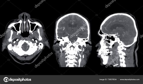 Computed Tomographic Angiography Scan Image Provides Insights Carotid