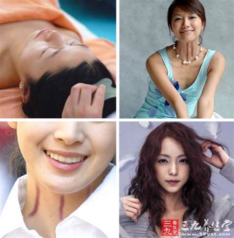 夏天中暑揪痧 紫痧 靓痧 第7页 大山谷图库