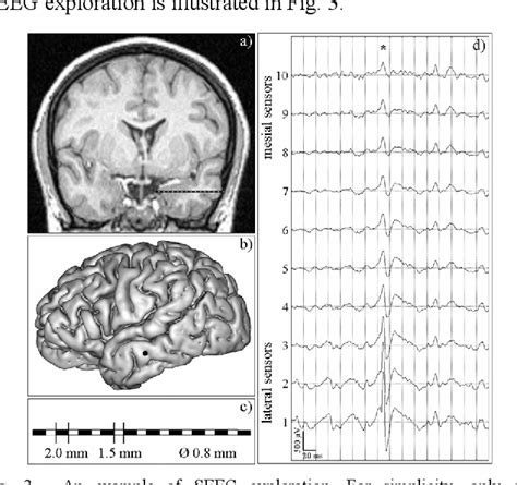 Figure 1 From A Physiologically Plausible Spatio Temporal Model For Eeg Signals Recorded With