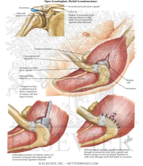 Open Acromioplasty Partial Acromionectomy