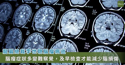 龍巖總裁李世聰腦瘤病逝！腦瘤症狀多變難察覺 Heho健康