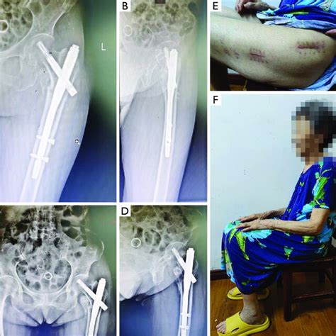 Postoperative And Follow Up Imaging A B X Rays Images 1 Month After Download Scientific