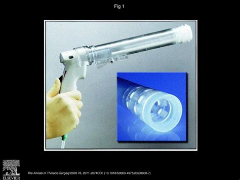 Novel surgical system for reducing lung tissue and preventing air leaks Eric Vallières MD FRSC