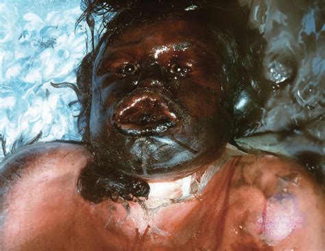 Putrefaction Indoors In Summertime After 60 Hours Since Death Herman