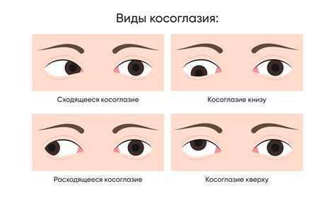Косоглазие Причины симптомы и методы лечения