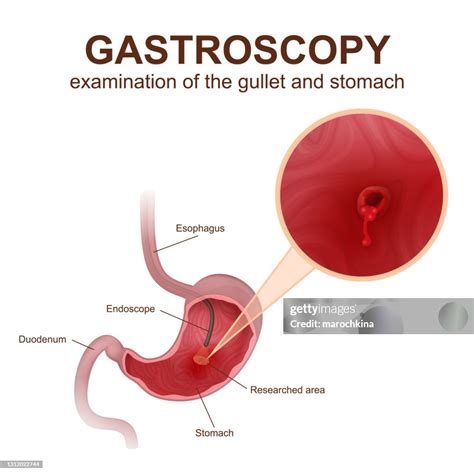 Gastroscopy Procedure Egd High Res Vector Graphic Getty Images