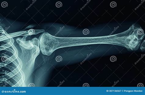 Radiograph Of The Shoulder Anatomy With Clavicle Scapula And Humerus