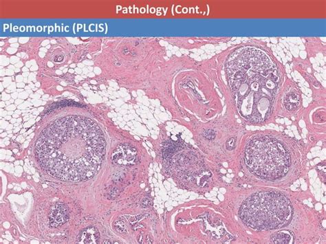 Lobular Carcinoma In Situ Lcis Pptx