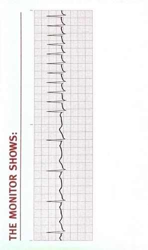 Cardiac Rhythms Flashcards Quizlet
