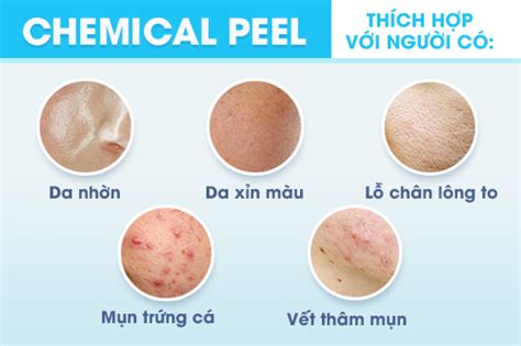 Dịch Vụ Peel Da Thay Da Sinh Học Uy Tín Hillsbeautyvn