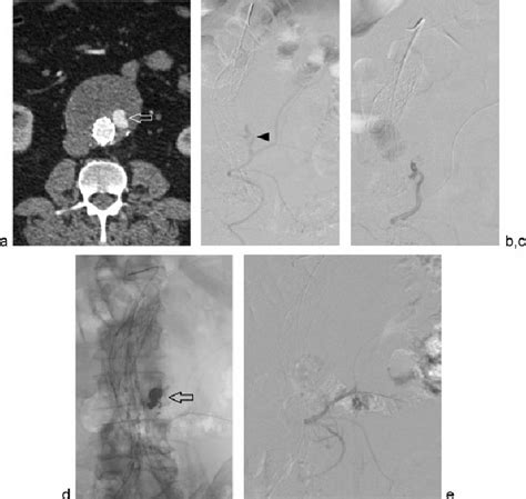 Type Ii Endoleak Treated With Transarterial Embolization A Computed