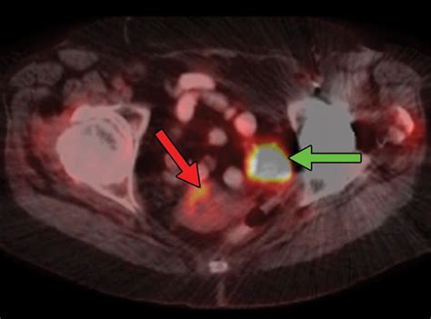 The Role Of Pet Ct In The Management Of Cervical Cancer Ajr