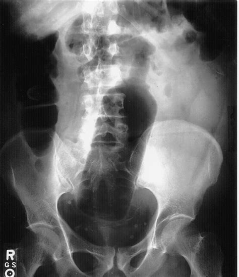 Foreign Bodies Insertions