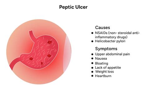 Sintomas De úlcera Estomacal úlcera Péptica Vetor Premium