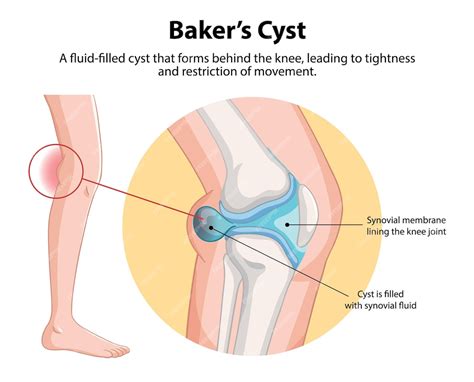 Free Vector Bakers Cyst In The Knee