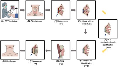 Intraoperative Nerve Monitoring In Thyroid Surgery Analysis Of Recurrent Laryngeal Nerve