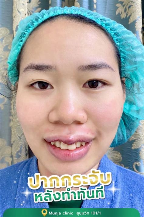 ปากกระจับสวยปัง ไม่โป๊ะ😊 Munja Clinic มันจาคลินิก Facebook