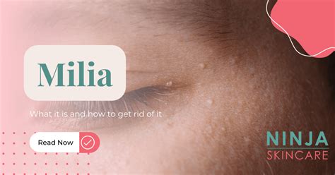 Milia Milk Spots