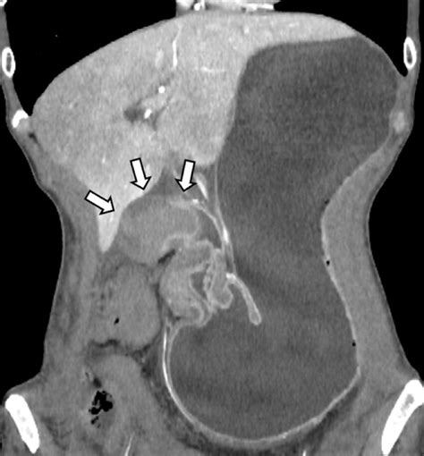 Contrast Enhanced Computed Tomography Revealed A Severely Distended