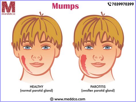 Parotid Gland Swelling Mumps