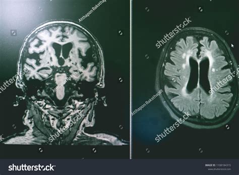 Cerebral Small Vessel Disease Images Stock Photos Vectors Shutterstock
