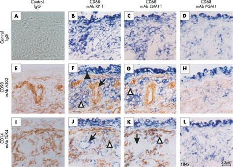Immunohistochemical Analysis Of Synovial Tissue From One Representative