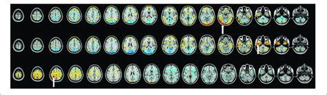Seed Based Correlation Map Of A Single Patient With 3 Representative Download Scientific