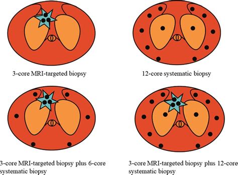 Frontiers Efficacy And Safety Of The New Biopsy Strategy Combining 6