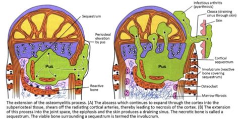 Pathology Lecture 16 Osteomyelitis Test 2 Flashcards Quizlet