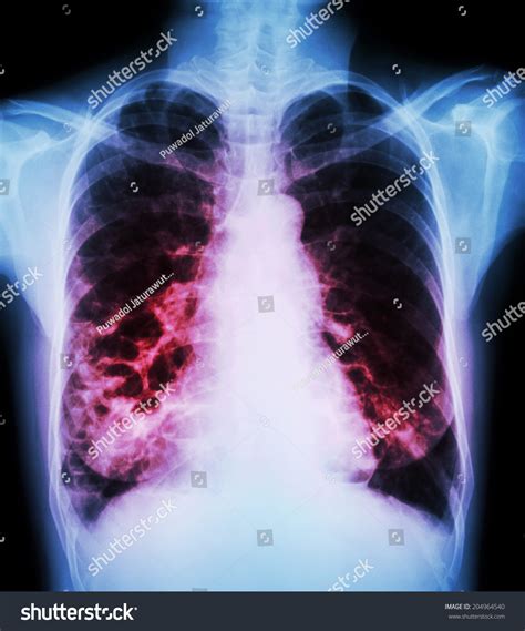 Bronchiectasis Xray Chest Show Multiple Lung Foto De Stock 204964540